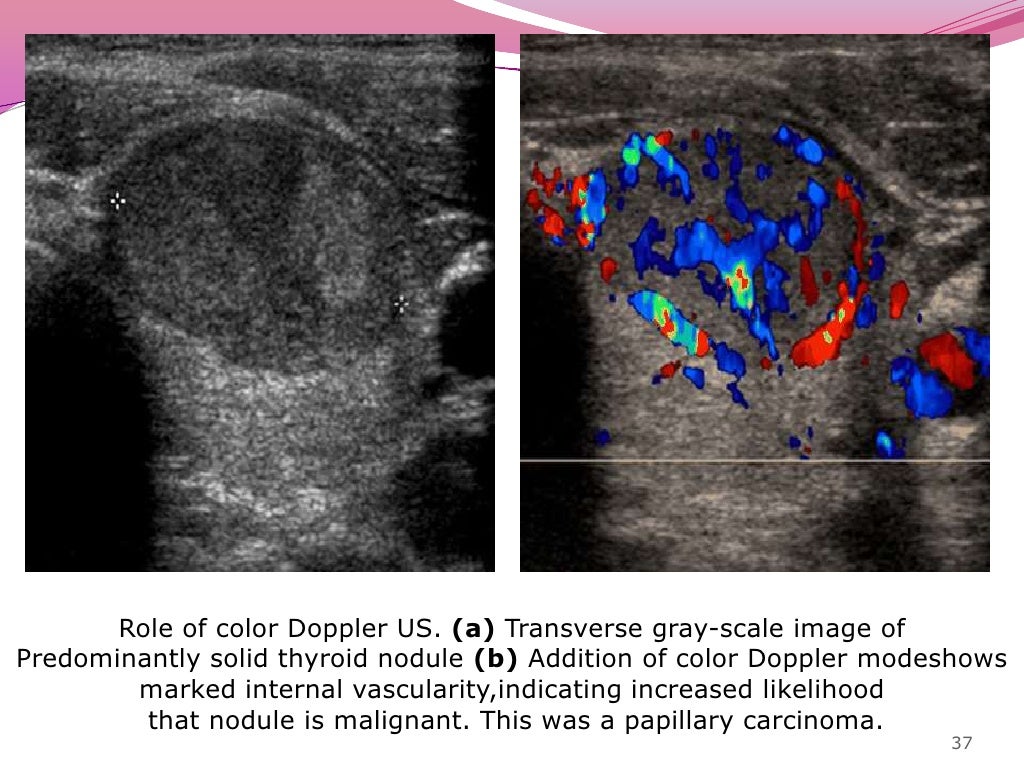 Dr Raj Bumiyas Thyroid Lesions Usg Ultrasonography