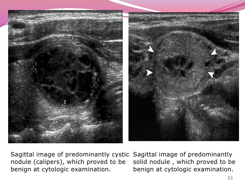 DR RAJ BUMIYA'S THYROID LESIONS USG - ULTRASONOGRAPHY