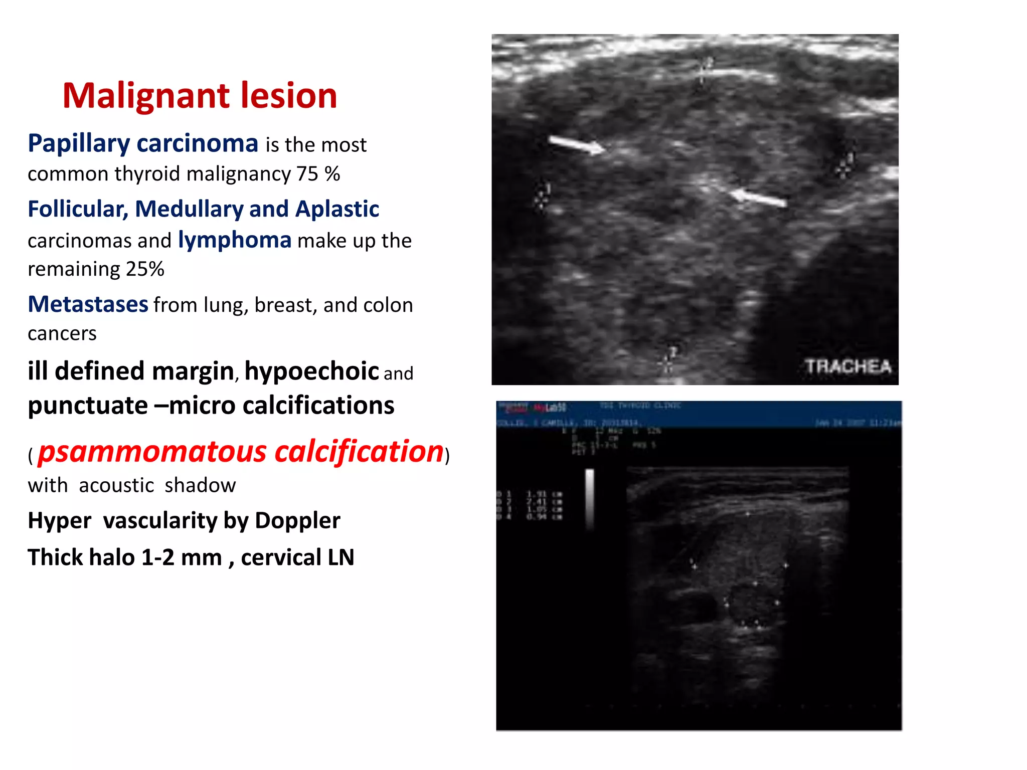 Thyroid lesions – evaluation with sonography | PPT