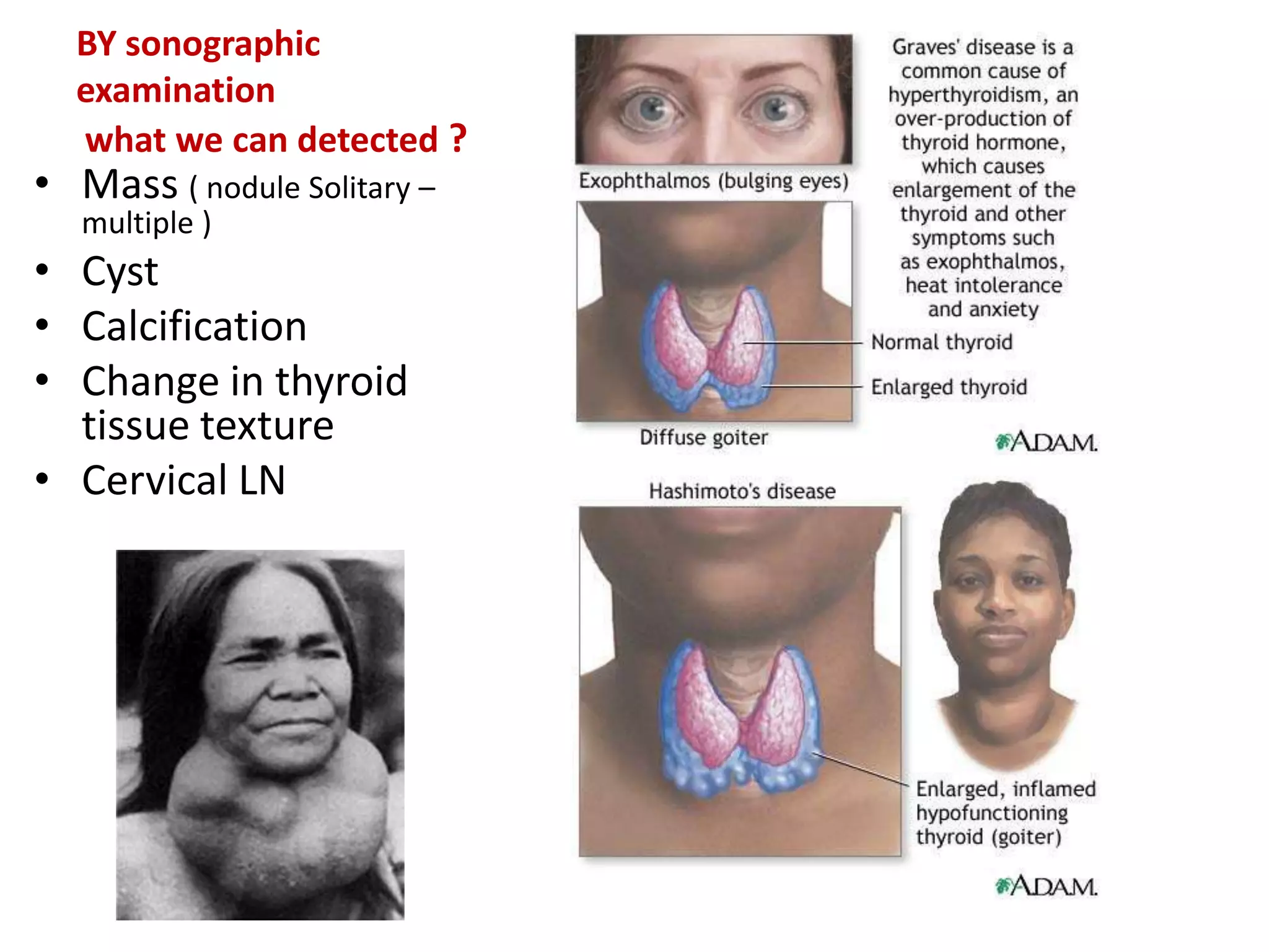Thyroid lesions – evaluation with sonography | PPT