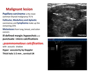 Thyroid lesions – evaluation with sonography | PPTX