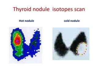 Thyroid lesions – evaluation with sonography | PPTX
