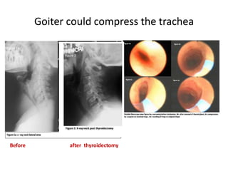 Thyroid lesions – evaluation with sonography | PPTX