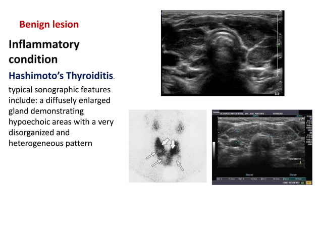 Thyroid lesions – evaluation with sonography | PPT