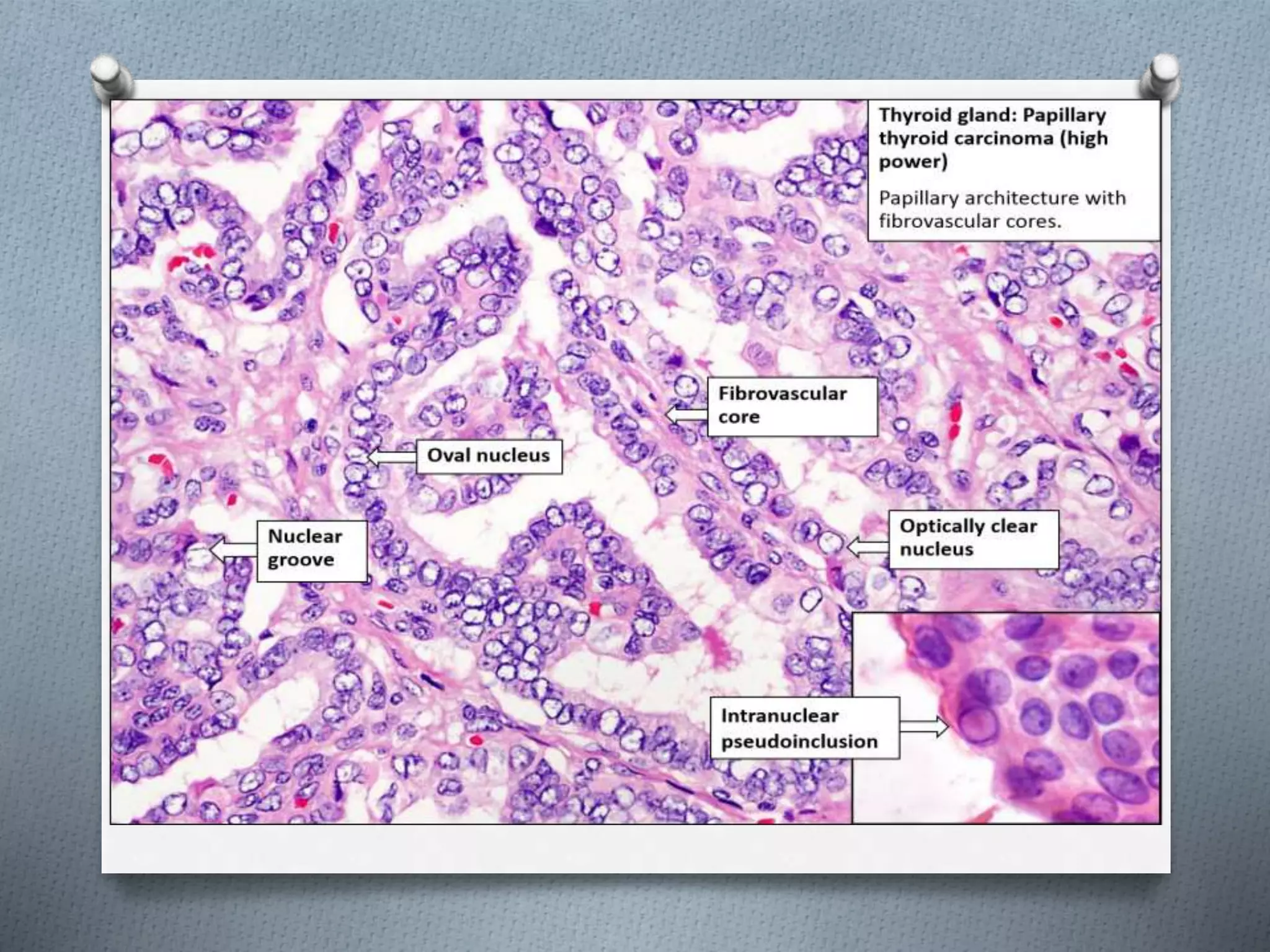 Thyroid Malignancy Ppt