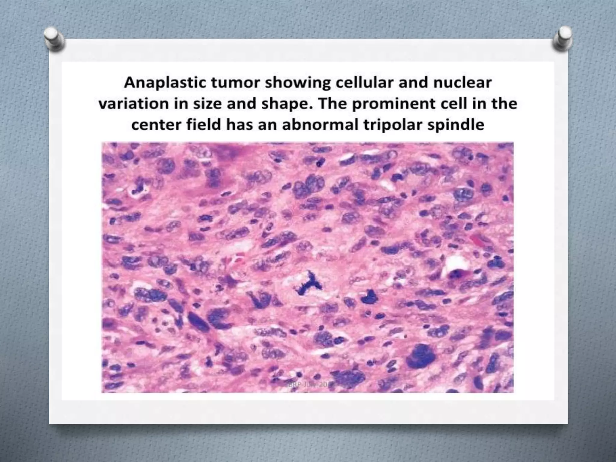Thyroid Malignancy Pptx