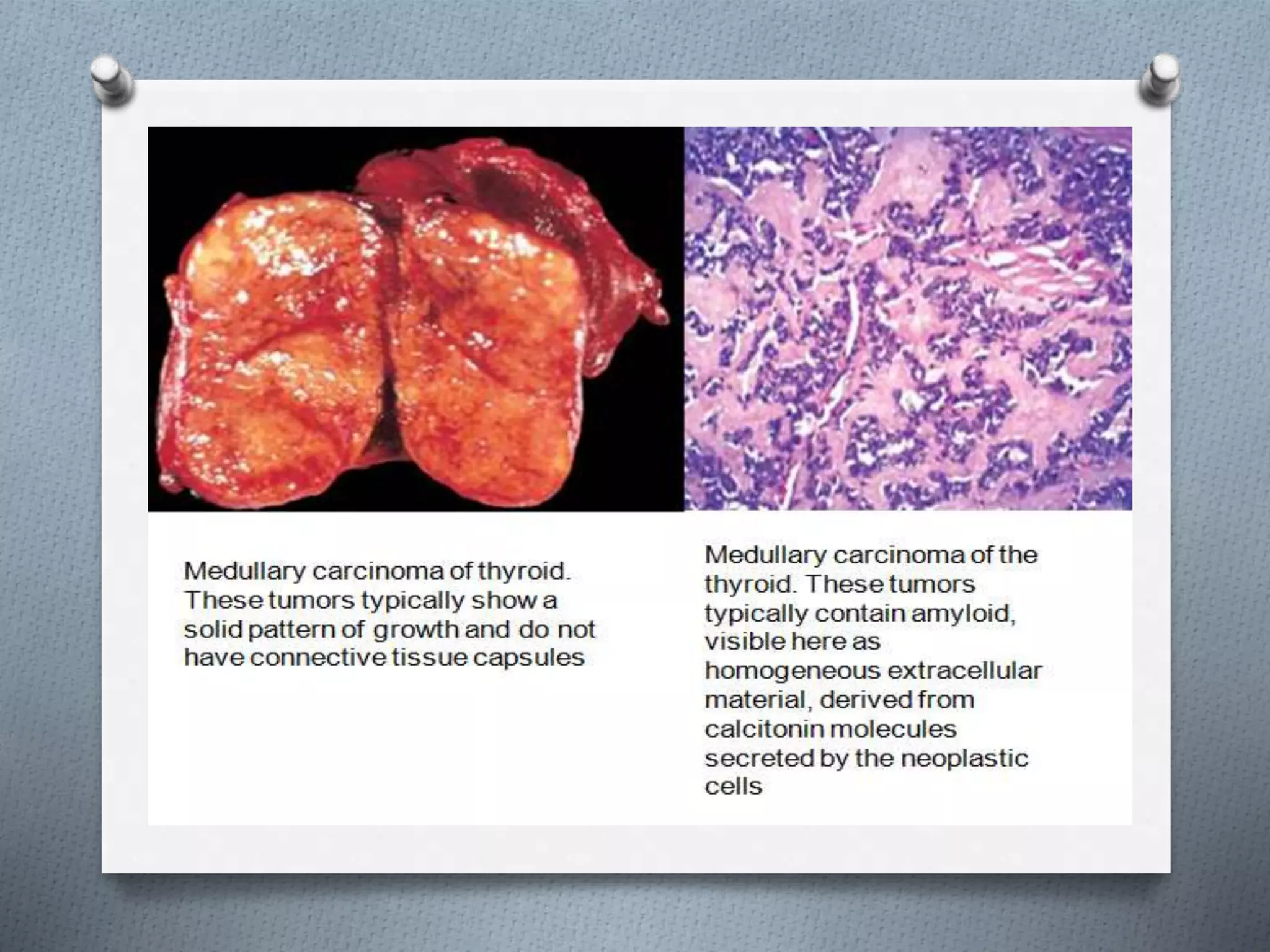 Thyroid Malignancy Ppt