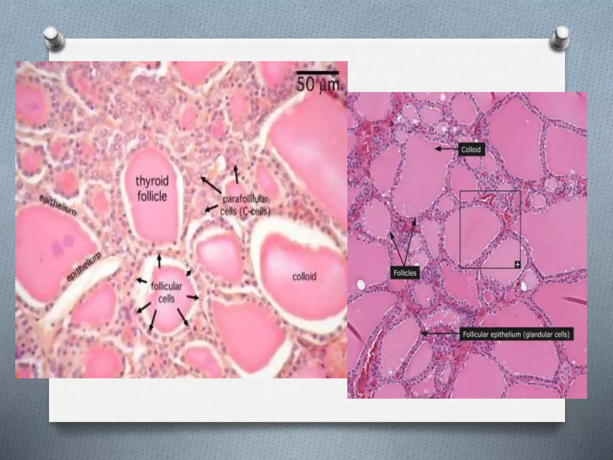 Thyroid Malignancy Ppt