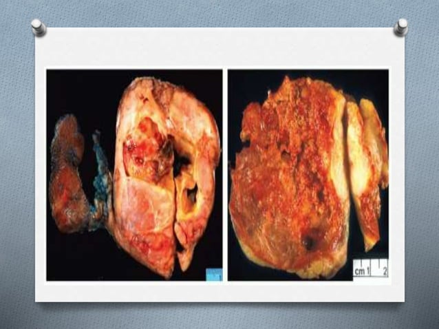 Thyroid Malignancy Ppt