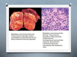 Thyroid malignancy | PPT
