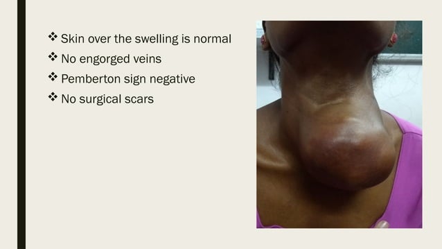 Thyroid Malignancy Prototype Case Pptx