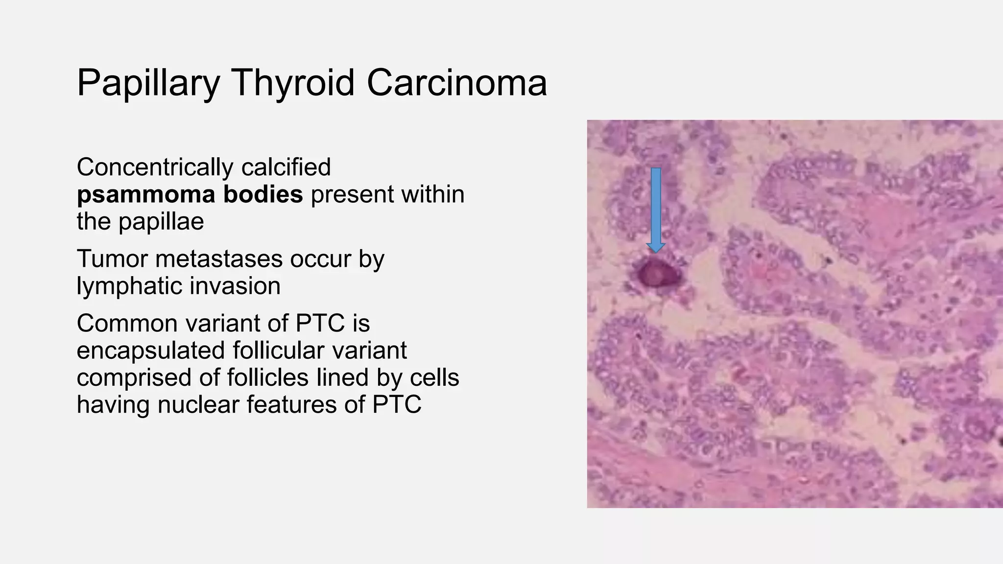 Thyroid neoplasms | PPTX