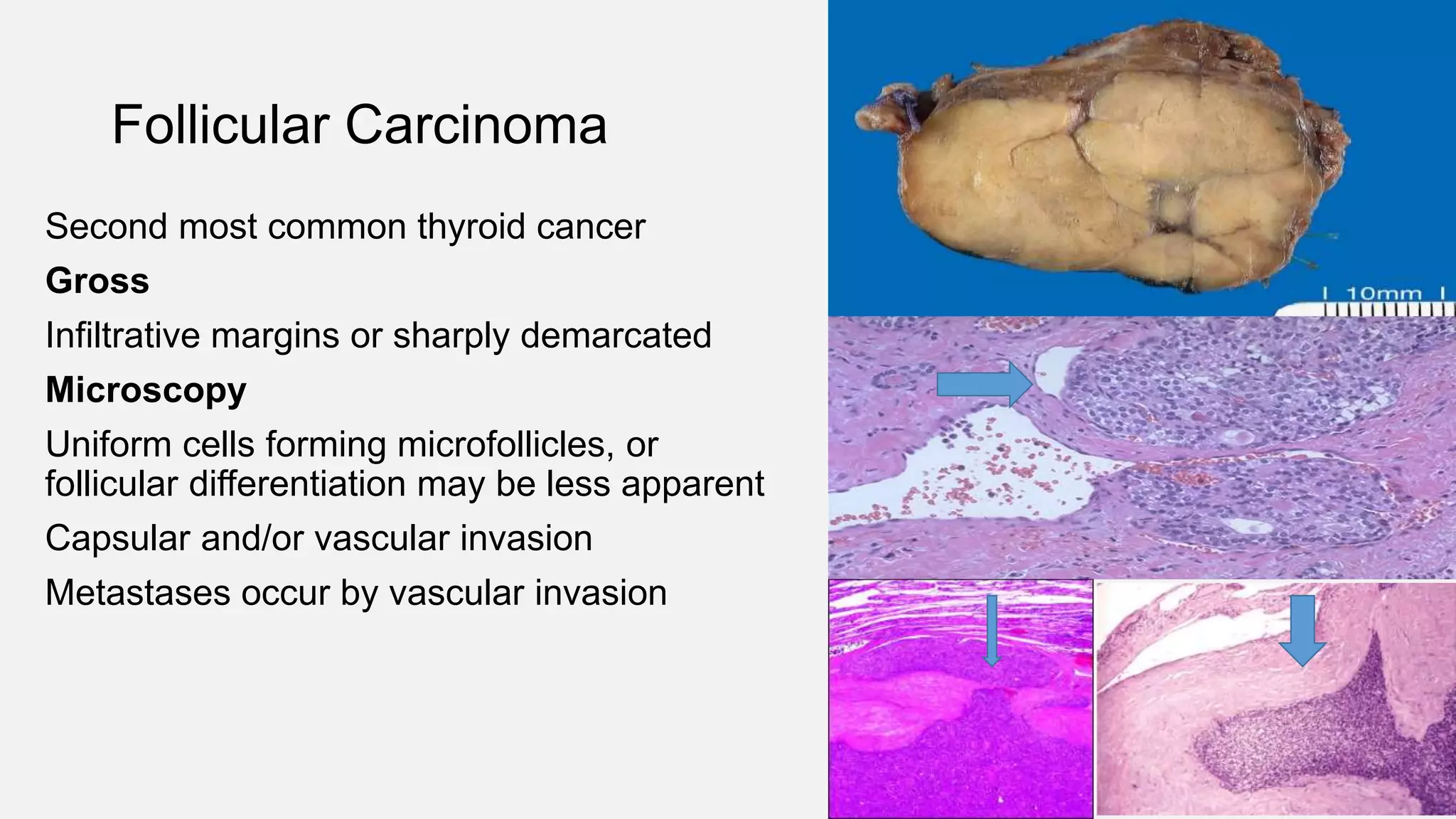Thyroid neoplasms | PPTX