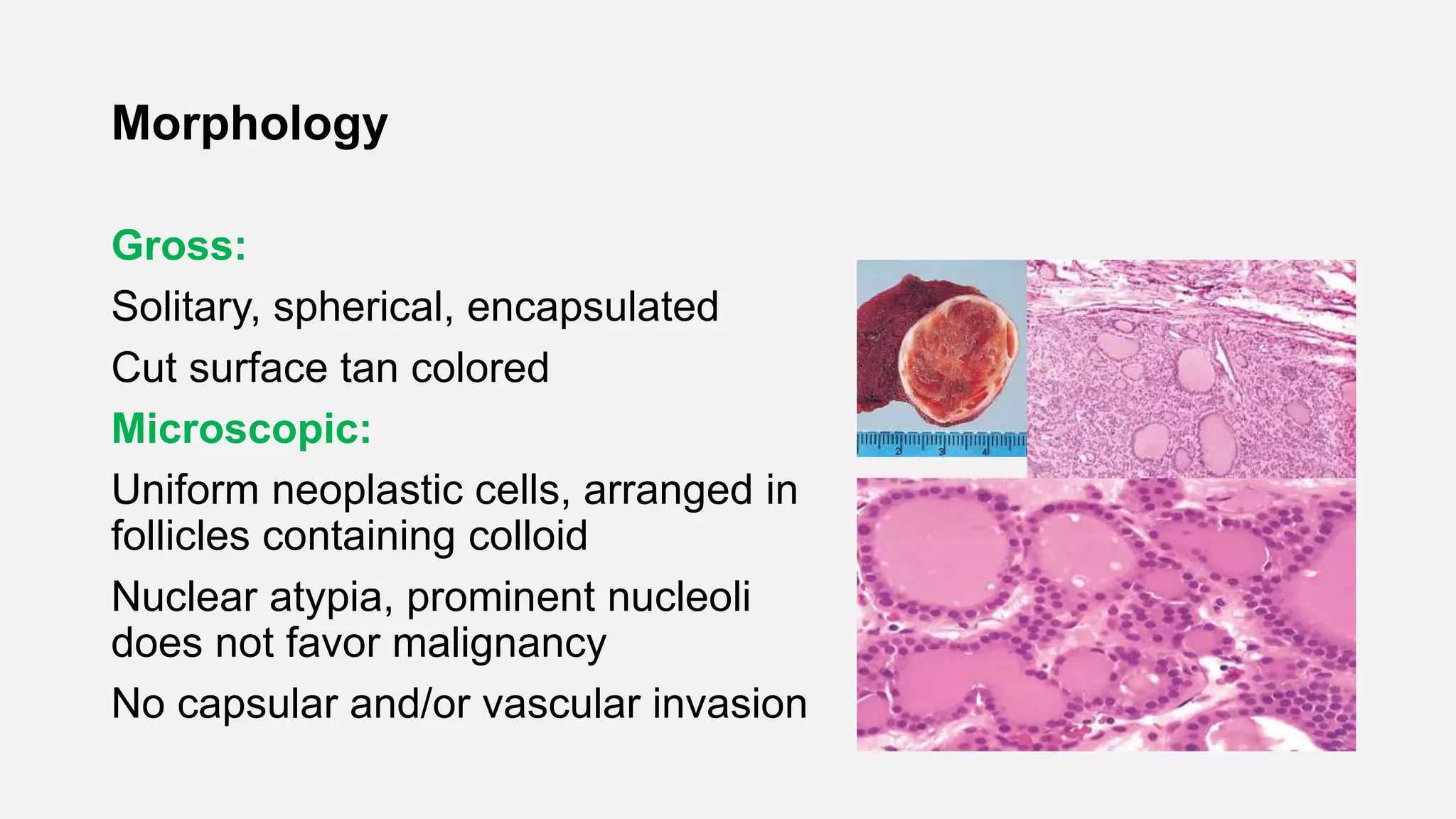 Thyroid neoplasms | PPTX