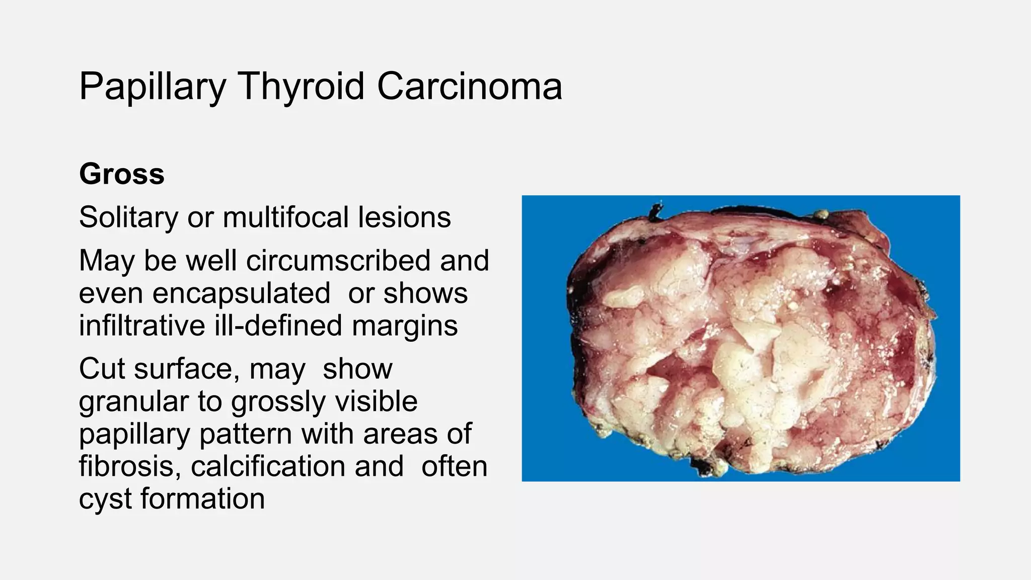 Thyroid neoplasms | PPTX