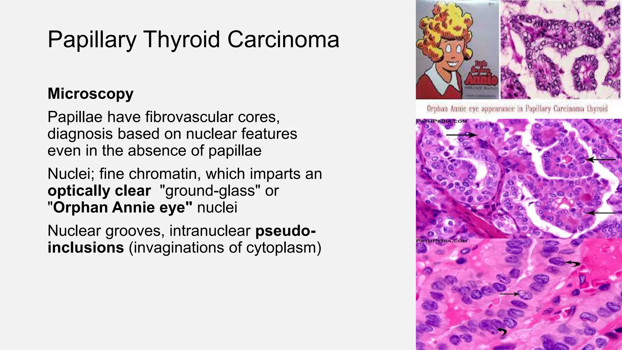 Thyroid neoplasms | PPTX