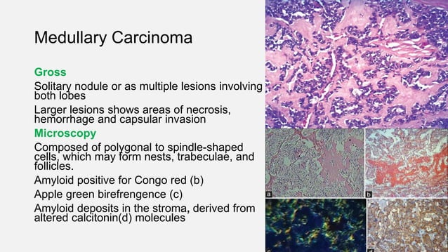 Thyroid neoplasms | PPTX