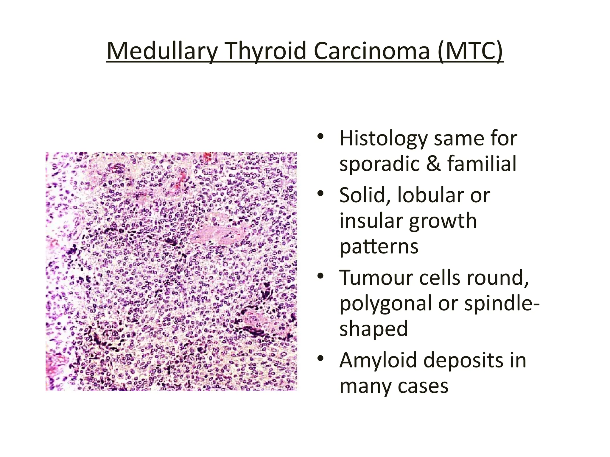 thyroid_neoplasms.ppt surgery thyroid carcinoma | PPT