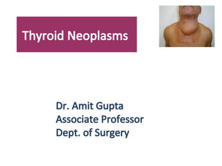 thyroid_neoplasms.ppt surgery thyroid carcinoma | PPT