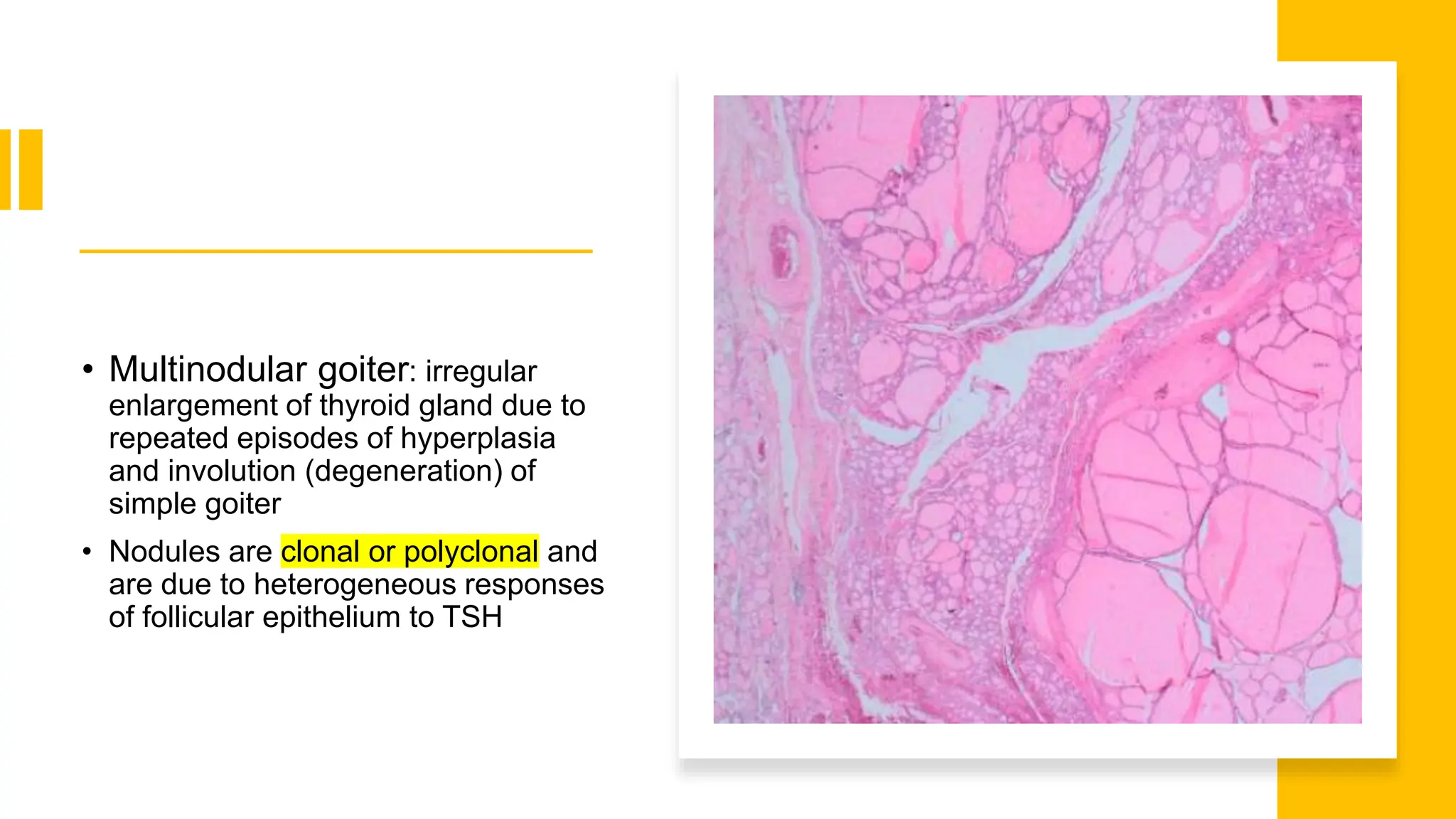 Thyroid Neoplasms an update based on latest WHO | PPTX
