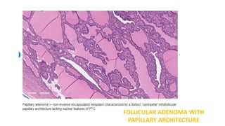 Thyroid Neoplasms an update based on latest WHO | PPTX