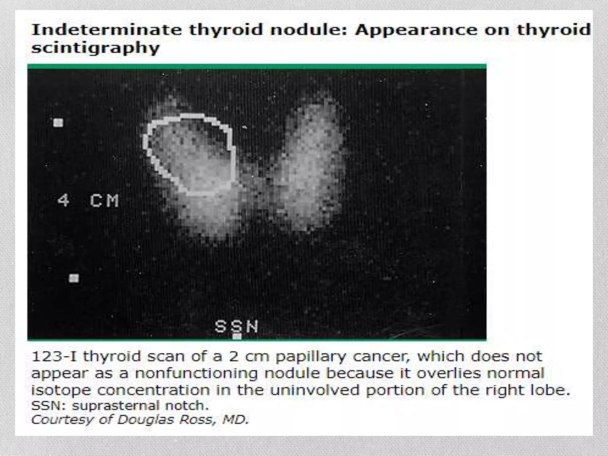 Approach To Thyroid Nodule Pptx Thyroid Disorders Endocrine And