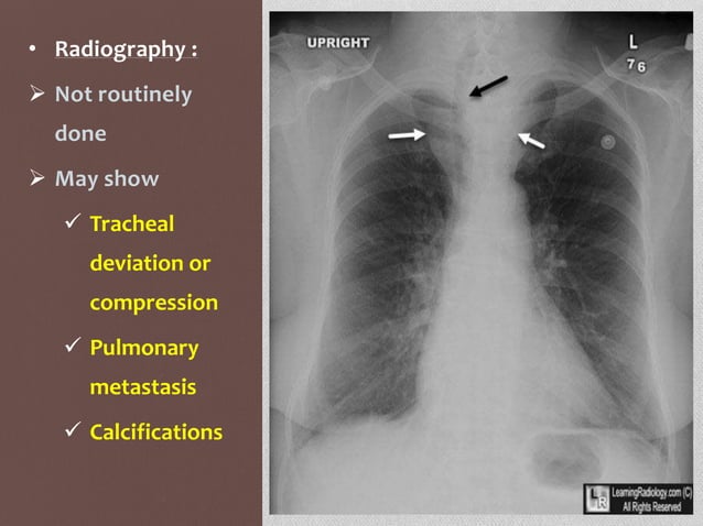 Approach To Thyroid Nodule Pptx Thyroid Disorders Endocrine And