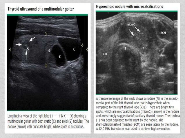 Approach To Thyroid Nodule Pptx Thyroid Disorders Endocrine And