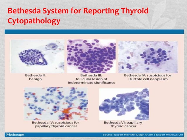 Approach To Thyroid Nodule Pptx