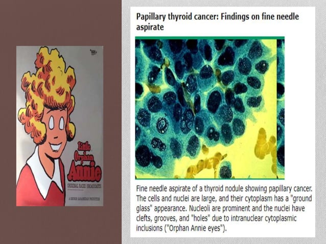 Approach To Thyroid Nodule Pptx