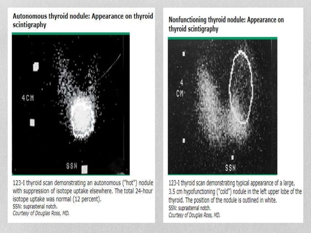 Approach To Thyroid Nodule Pptx