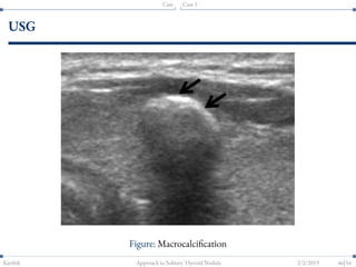 Approach to Solitary Thyroid nodule | PDF