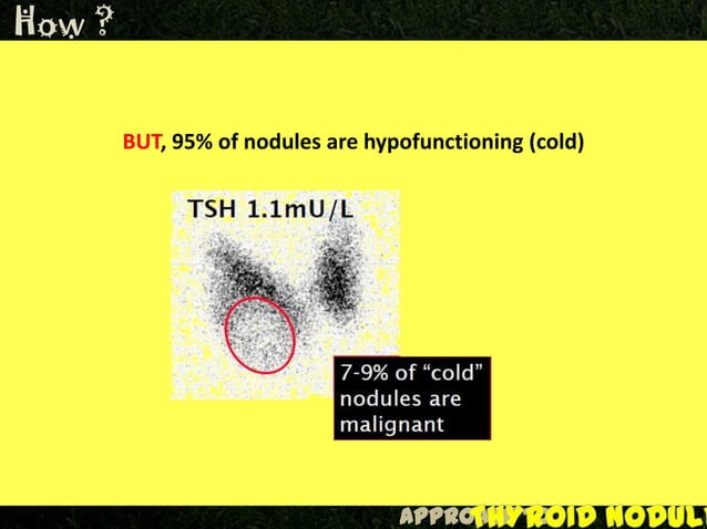 Approach To Thyroid Nodules Ppt
