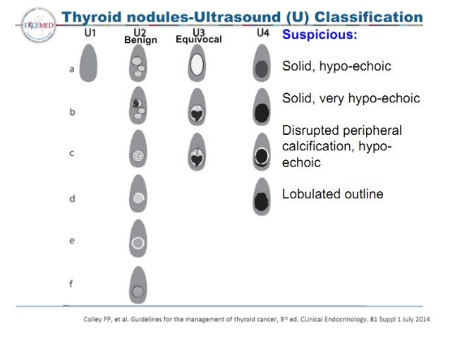 Thyroid nodules and cancer