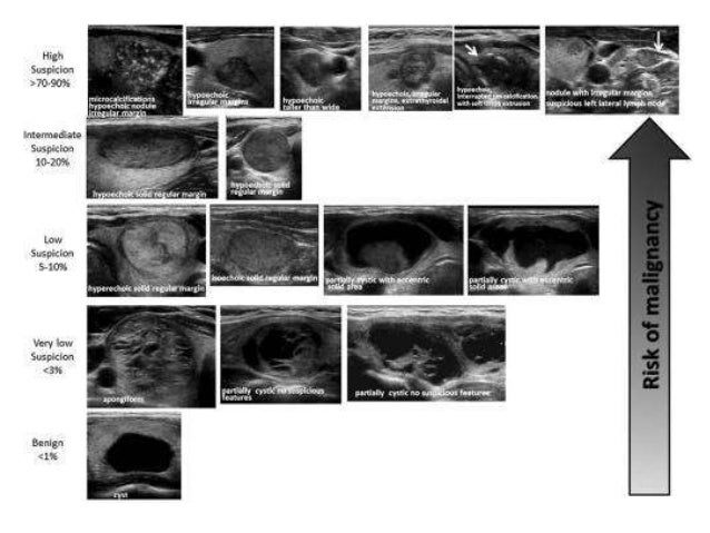 Thyroid nodules ATA guideline 2017