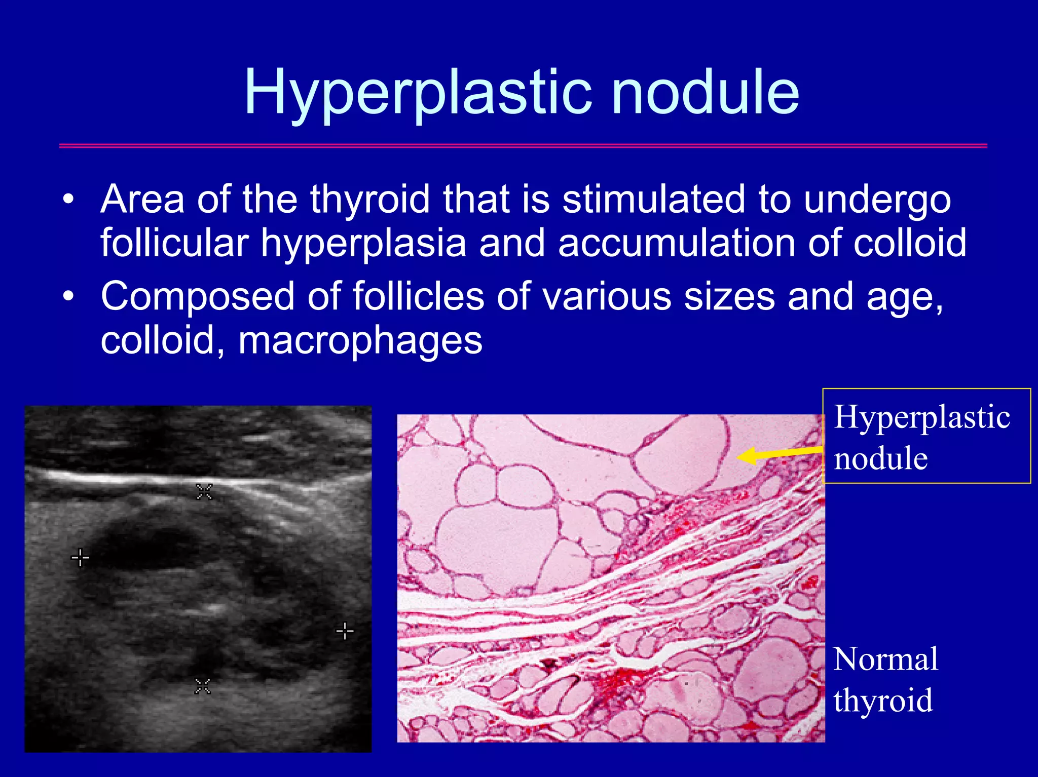 The Epidemic of Thyroid Nodules: Which Should Undergo Fine Needle ...
