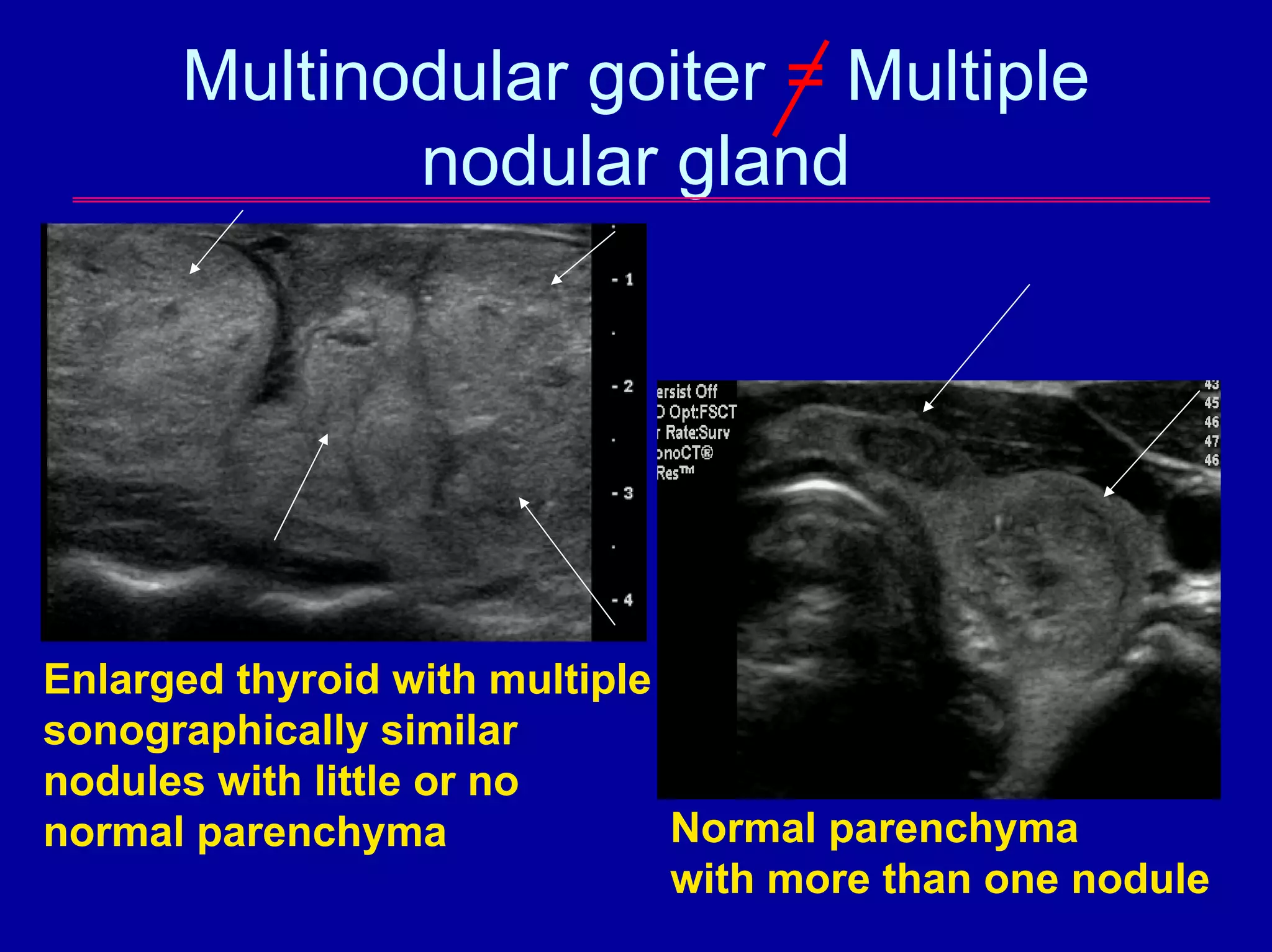 The Epidemic of Thyroid Nodules: Which Should Undergo Fine Needle ...