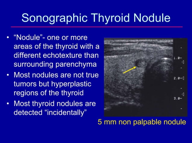 The Epidemic of Thyroid Nodules: Which Should Undergo Fine Needle ...