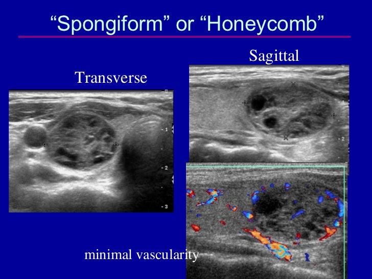 The Epidemic of Thyroid Nodules: Which Should Undergo Fine Needle Asp…