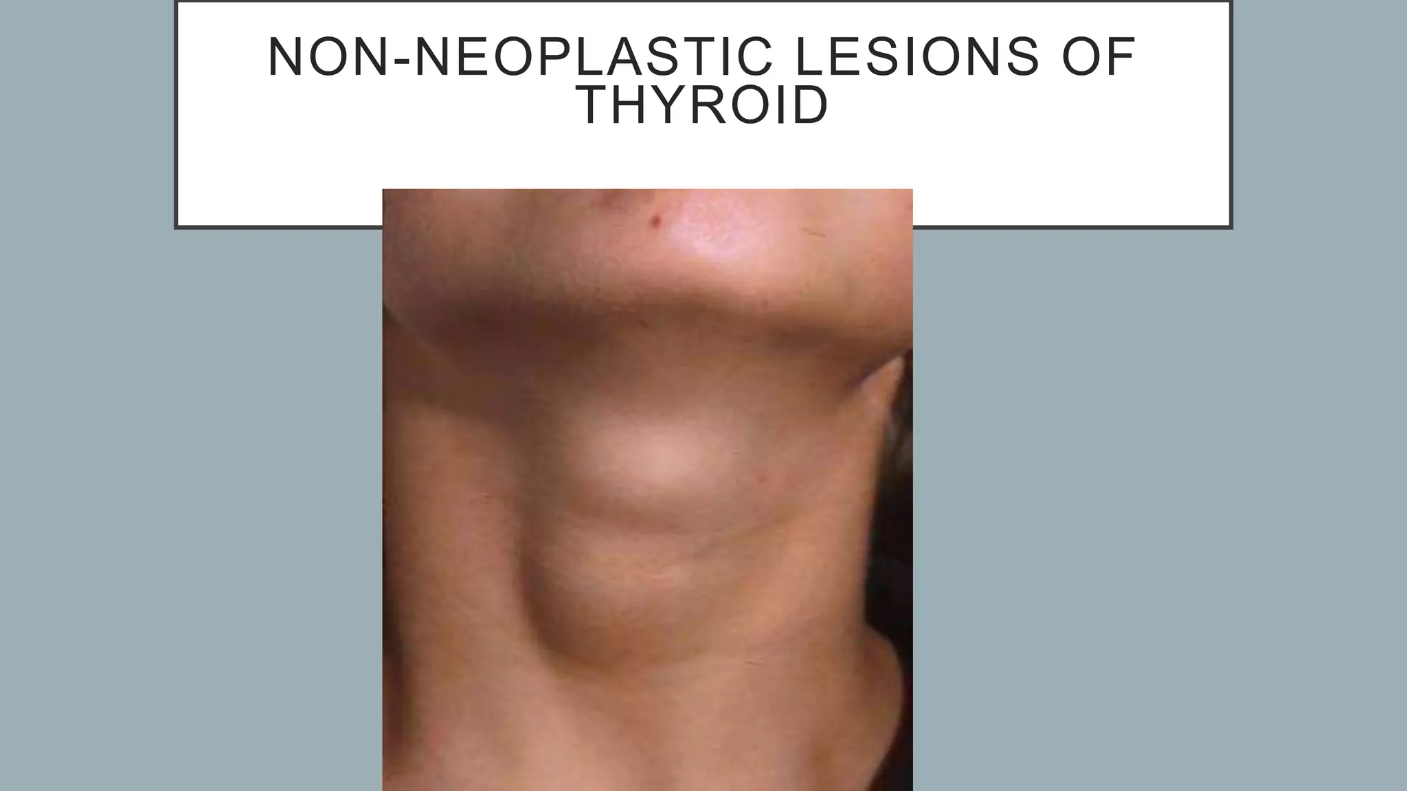 Thyroid non neoplastic lesions | PPTX