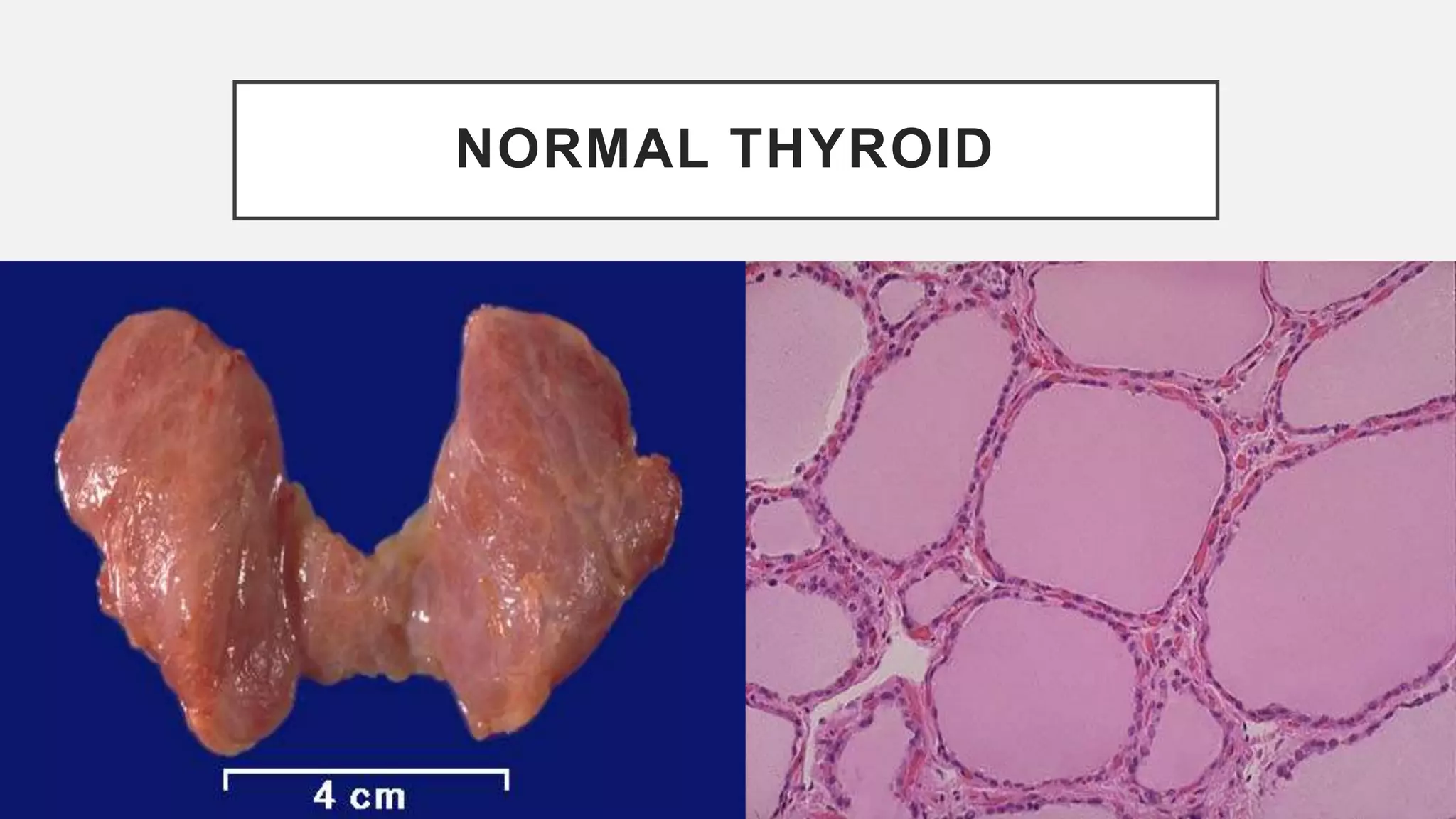 Thyroid non neoplastic lesions | PPTX