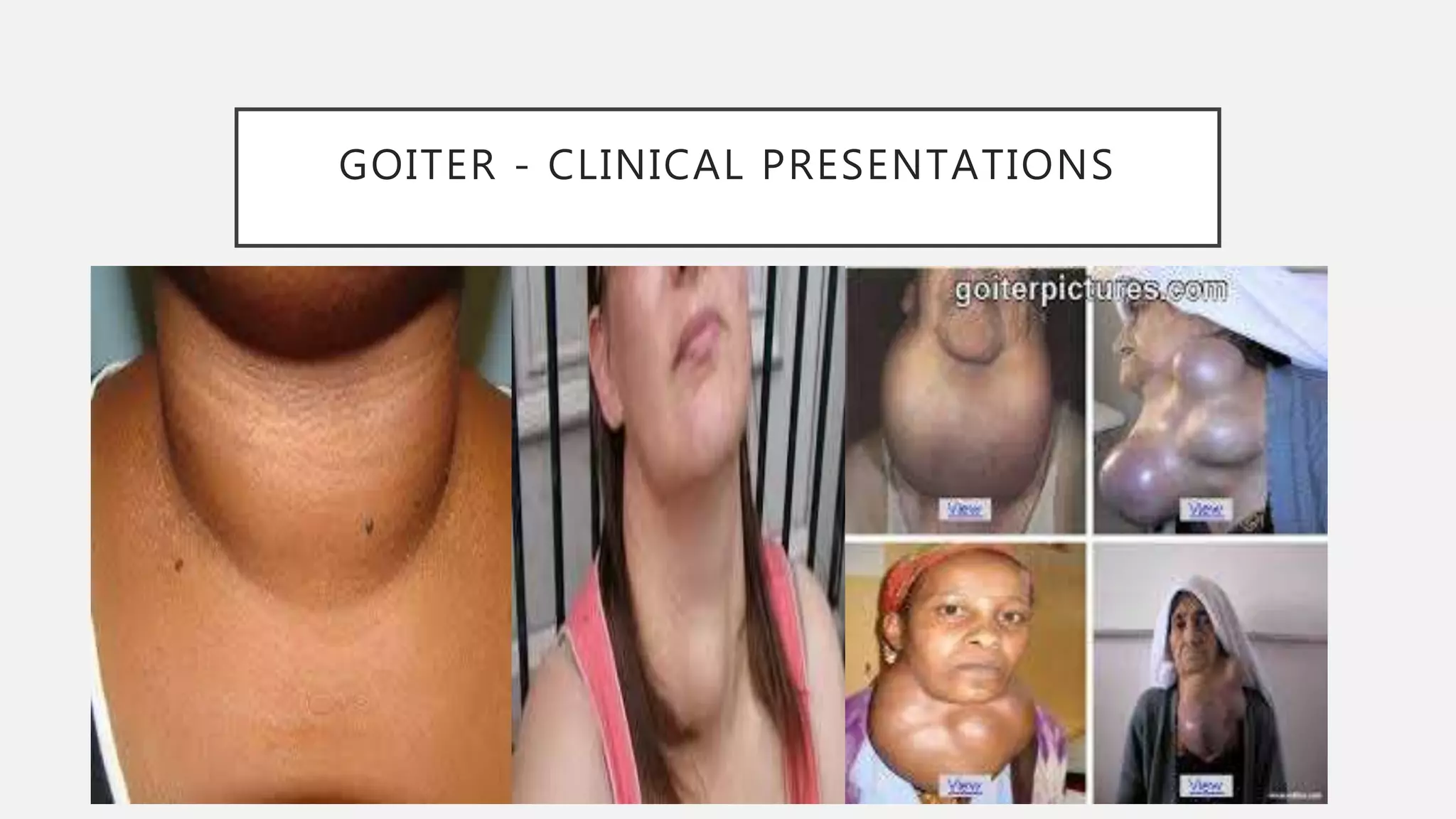 Thyroid non neoplastic lesions | PPTX