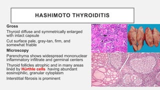 Thyroid non neoplastic lesions | PPTX