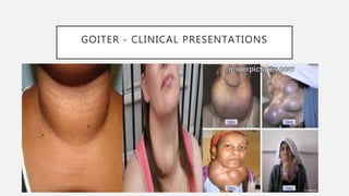 Thyroid non neoplastic lesions | PPTX