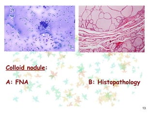 Thyroid Noudle | PPT
