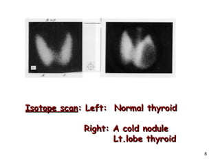Thyroid Noudle | PPT