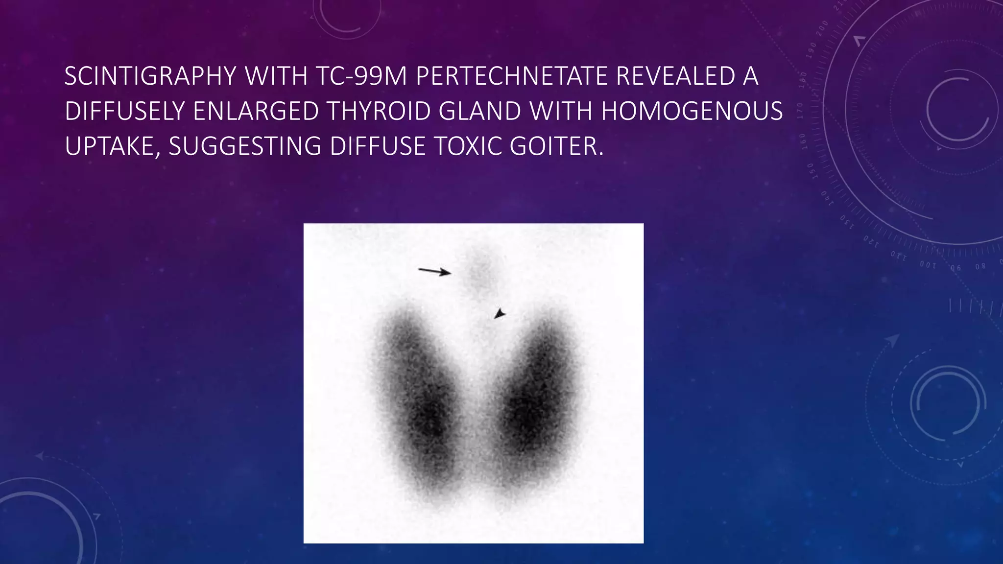 Thyroid scan | PPTX