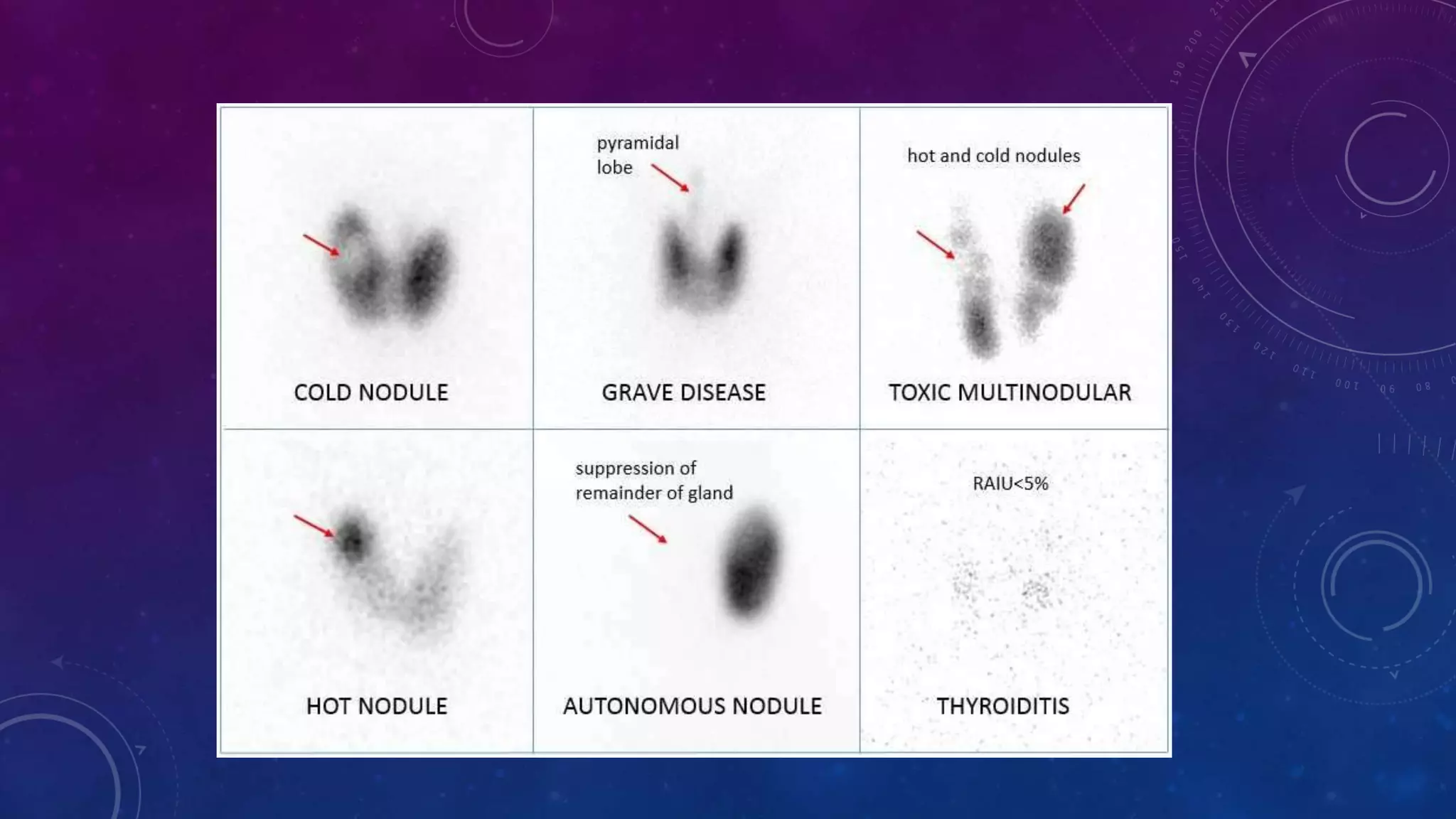 Thyroid scan | PPTX
