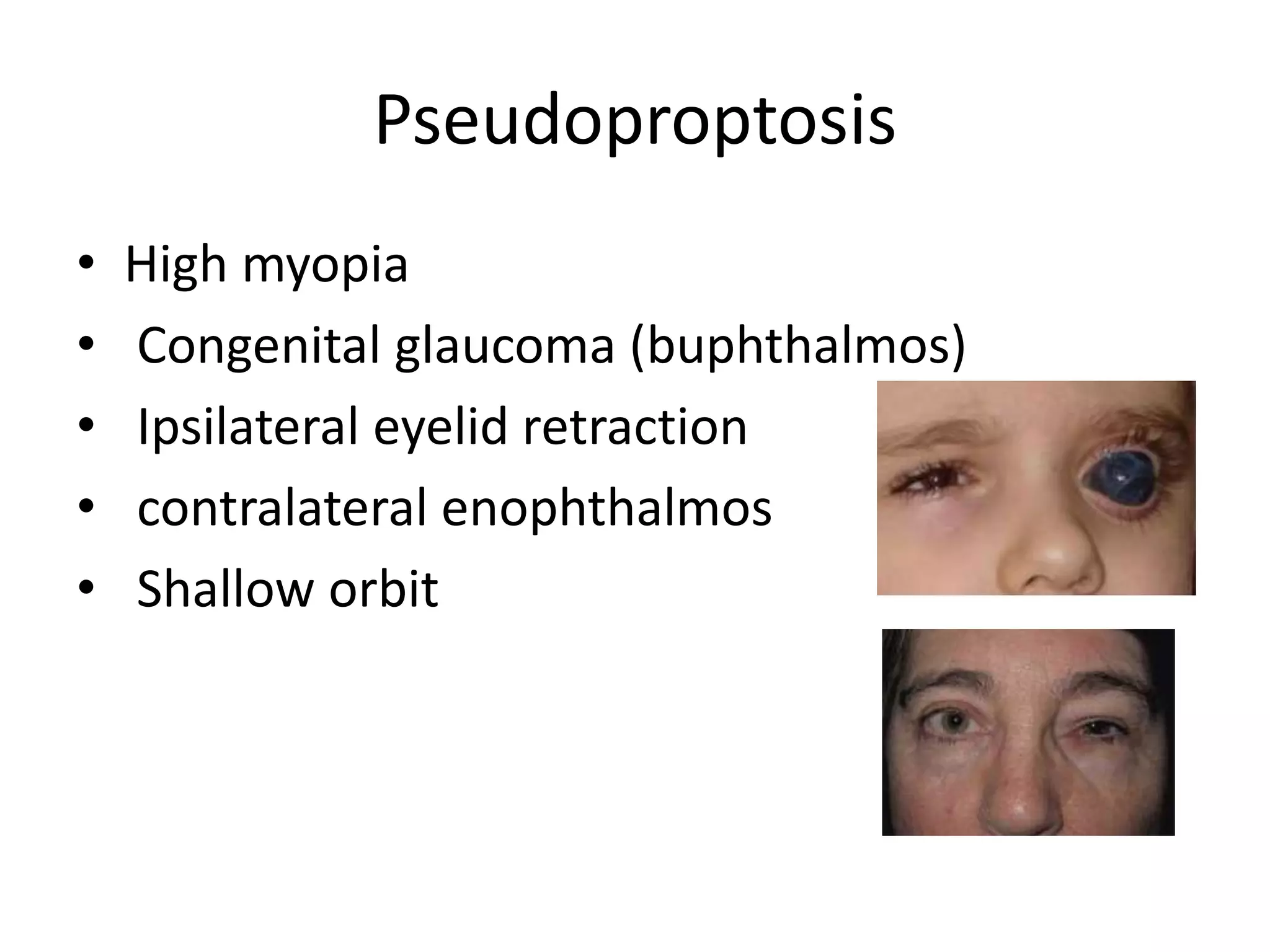 Thyroid ophthalmopathy | PPTX