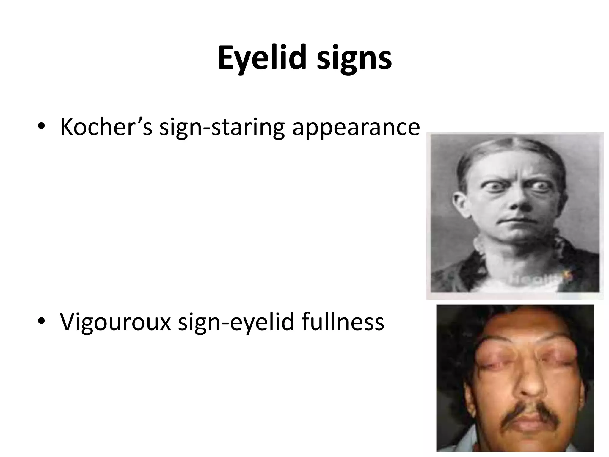 Thyroid ophthalmopathy | PPTX